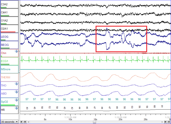 Developing a deep learning-based portable diagnostic system for sleep ...